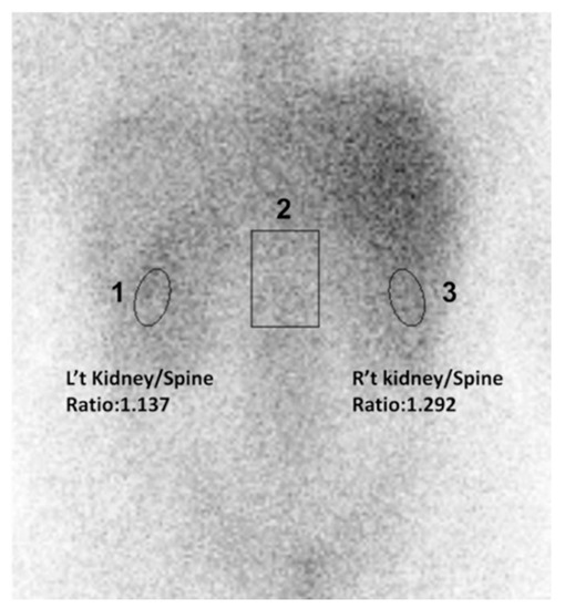 Diagnosis And Corresponding Gallium Scan