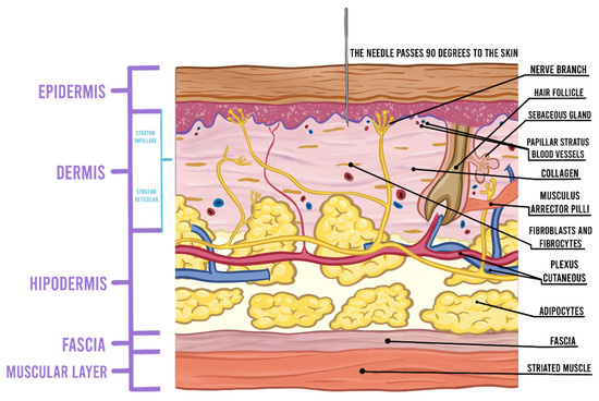 Updates on Wound Infiltration Use for Postoperative Pain Management: A ...