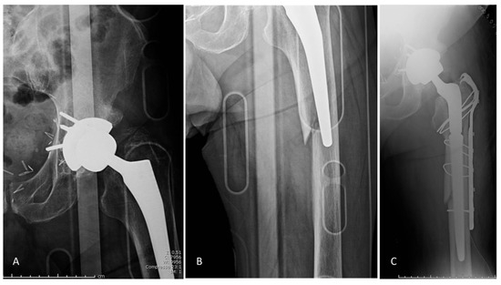 Use of a Plasma-Sprayed Titanium-Hydroxyapatite Femoral Stem in Hip ...