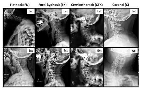 JCM | Free Full-Text | Surgical Strategy for the Management of Cervical ...