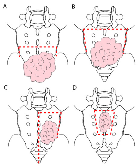 Towards Standardisation of Technique for En Bloc Sacrectomy for Locally ...