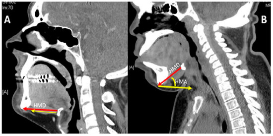 Hyo-Mental Angle and Distance: An Important Adjunct in Airway ...
