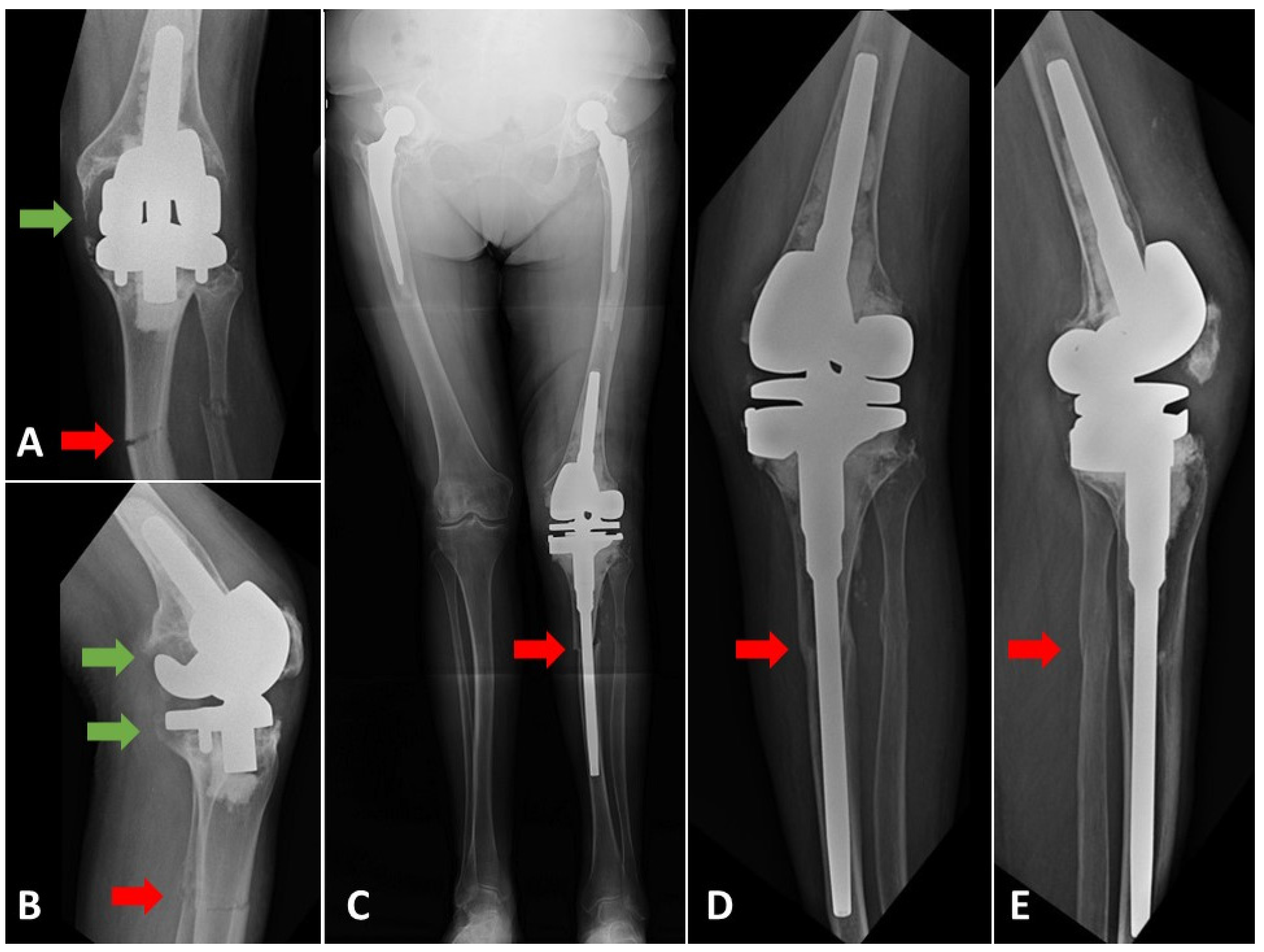 Tibia Fracture After Total Knee Replacement At Herman Dunlap Blog