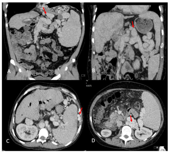 Liver Transplantation for Biliary Atresia in Adulthood: Single-Centre ...
