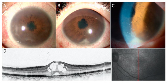 Ocular Involvement in Relapsing Polychondritis