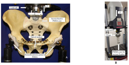 Is Anterior Plating Superior to the Bilateral Use of Retrograde ...