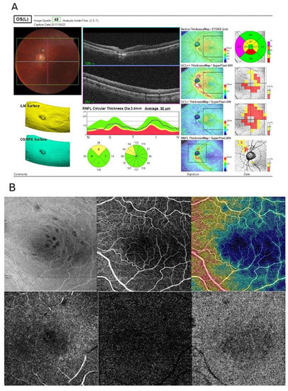 Assessment of Vascular Changes in Patients after Pars Plana Vitrectomy ...