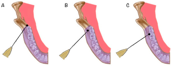 JCM | Free Full-Text | Comparative Study between the Combination of ...
