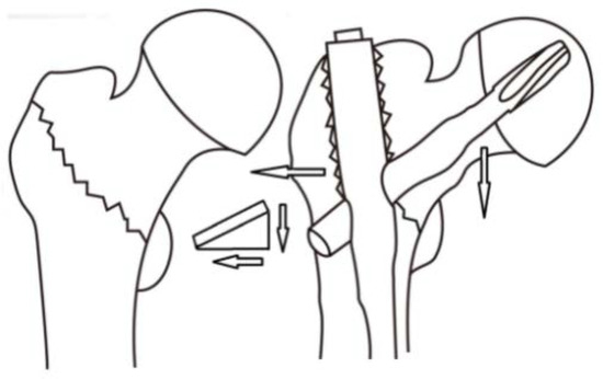 Impact of Wedge Effect on Outcomes of Intertrochanteric Fractures ...