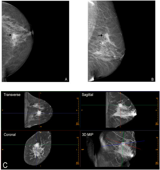 Cone-Beam Breast Computed Tomography: Time for a New Paradigm in Breast ...