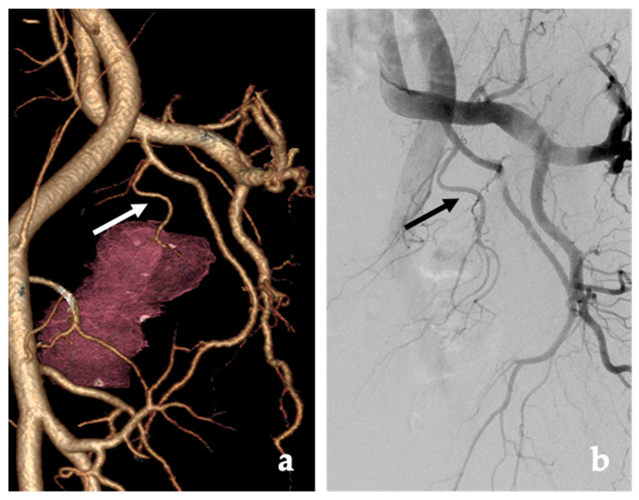 Jcm Free Full Text Prostate Artery Embolization—review Of