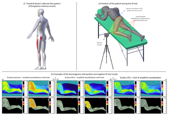 Gluteal Reflex Test