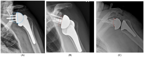 Current Concepts in Humeral Component Design for Anatomic and Reverse ...