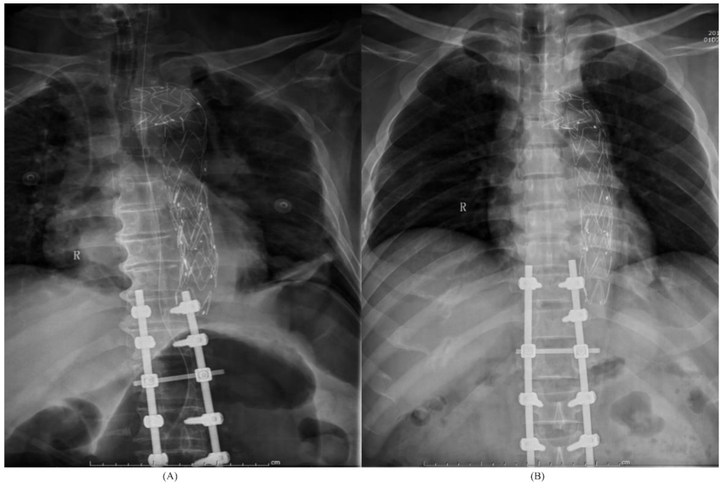 Thoracic Spine Fractures with Blunt Aortic Injury: Incidence, Risk ...