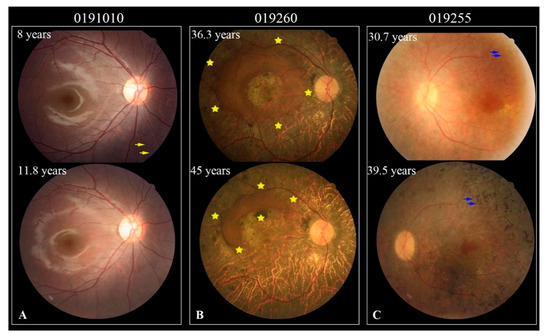 Clinical Features and Natural History in a Cohort of Chinese Patients ...