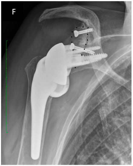 JCM | Free Full-Text | Reverse Shoulder Arthroplasty with Bony and ...