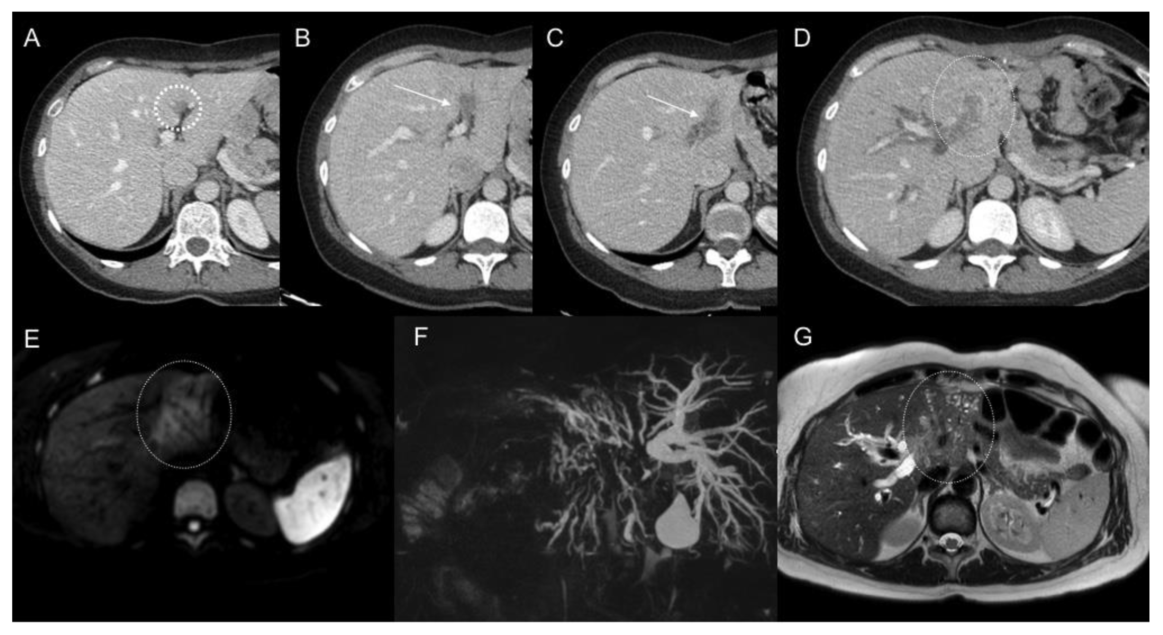 Imaging Of Gastric Carcinomatosis