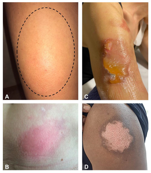 Cutaneous Adverse Reactions Associated with SARS-CoV-2 Vaccines