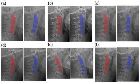 Estimating Cervical Vertebral Maturation with a Lateral Cephalogram Using the Convolutional ...