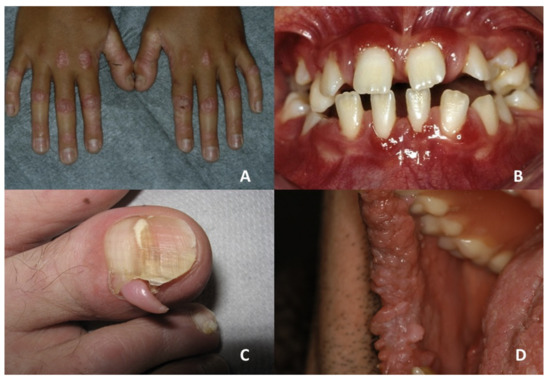 Oral Mucosa and Nails in Genodermatoses: A Diagnostic Challenge