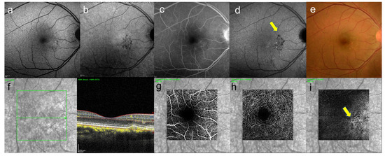 Retinal Diseases Regulated by Hypoxia—Basic and Clinical Perspectives ...