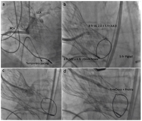 The Use of BASILICA Technique to Prevent Coronary Obstruction in a TAVI ...