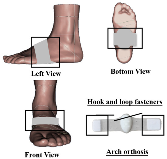 JCM | Free Full-Text | Arch-Support Induced Changes in Foot-Ankle ...