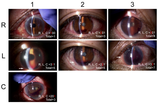 JCM | Free Full-Text | Comparison of Postoperative Hyphemas between ...