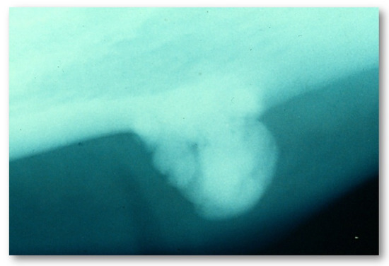 Craniofacial Osteomas: From Diagnosis to Therapy