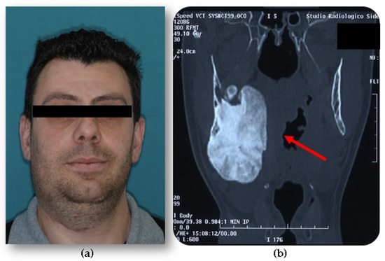 Craniofacial Osteomas: From Diagnosis to Therapy