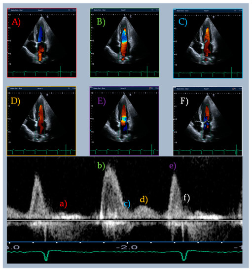 Mid-Diastolic Events (L Events): A Critical Review