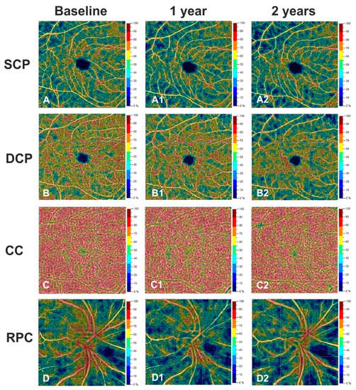 Retinal and Choriocapillary Vascular Changes in Early Stages of ...