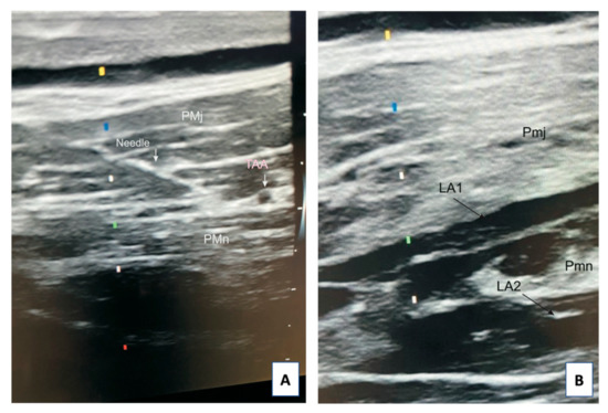 Evaluation of the Effectiveness of Modified Pectoral Nerve Blocks Type ...