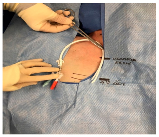 Safety of Bedside Placement of Tunneled Hemodialysis Catheters in the ...