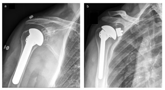 Glenoid Component Position Does Not Affect Short-Term Clinical and ...