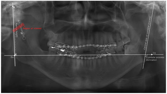 Semi-Rigid Fixation Using a Sliding Plate for Treating Fractures of the ...