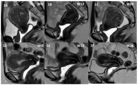 Jcm Free Full Text Uterine Adenomyosis Treated By Linzagolix An