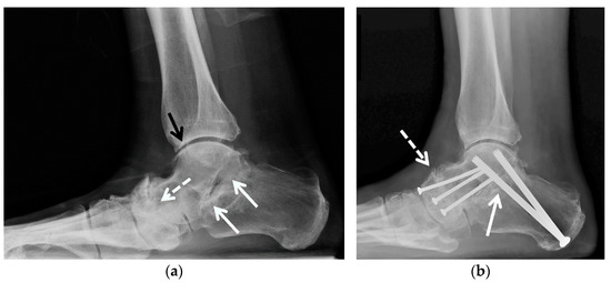 Imaging and Treatment of Posttraumatic Ankle and Hindfoot Osteoarthritis