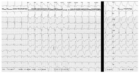 JCM | Free Full-Text | Anodal Capture for Multisite Pacing with a ...