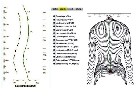Morphology, Development and Deformation of the Spine in Mild and ...