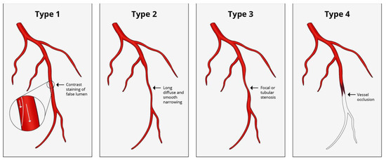 Spontaneous Coronary Artery Dissections: A Systematic Review