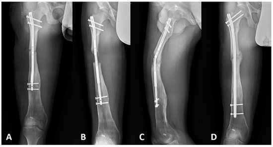 Comparison of Intramedullary Magnetic Nail, Monolateral External Distractor, and Spatial ...