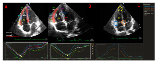 Preload Dependency of 2D Right Ventricle Speckle Tracking ...