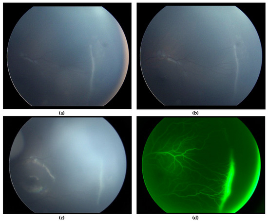 Treatment outside the Recommended Guidelines for Retinopathy of ...