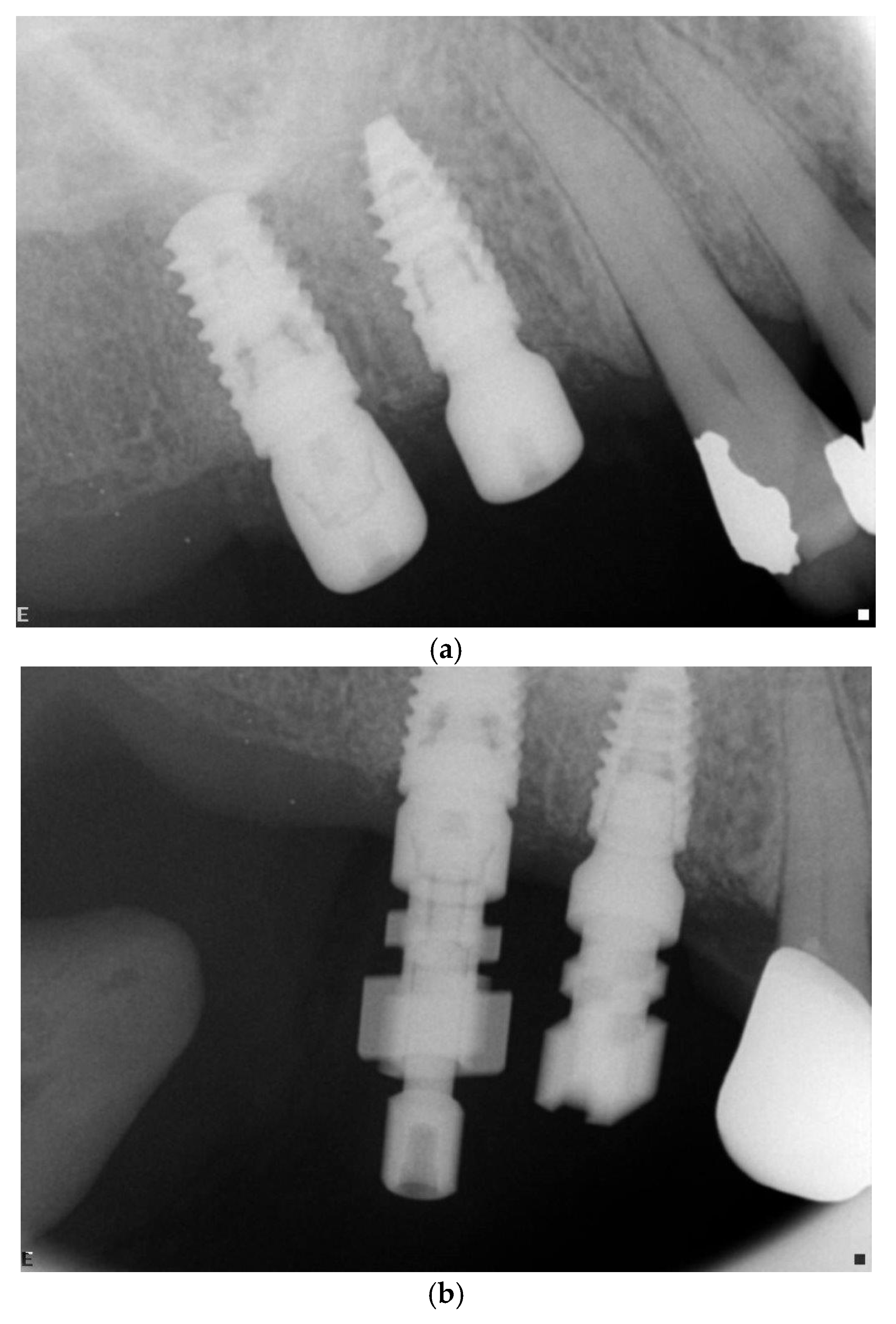 The Association of the One-Abutment at One-Time Concept with Marginal ...