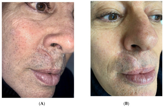 Plasma Radiofrequency Ablation for Scar Treatment