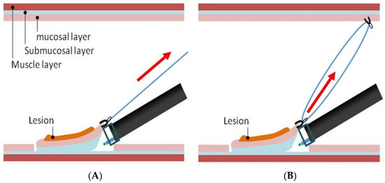 Effectiveness of S-O Clip-Assisted Colorectal Endoscopic Submucosal ...