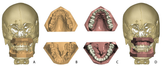 Operator Performance of the Digital Setup Fabrication for Orthodontic ...