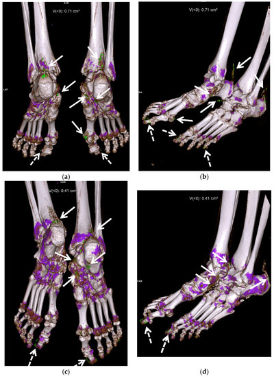 Gouty Arthropathy: Review of Clinical Manifestations and Treatment ...