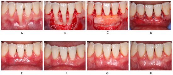 Coronally Advanced Flap with Connective Tissue Graft for Treating ...